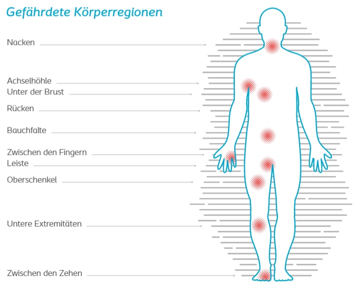 InterDry - die effektive Lösung zur Versorgung von Hautfalten